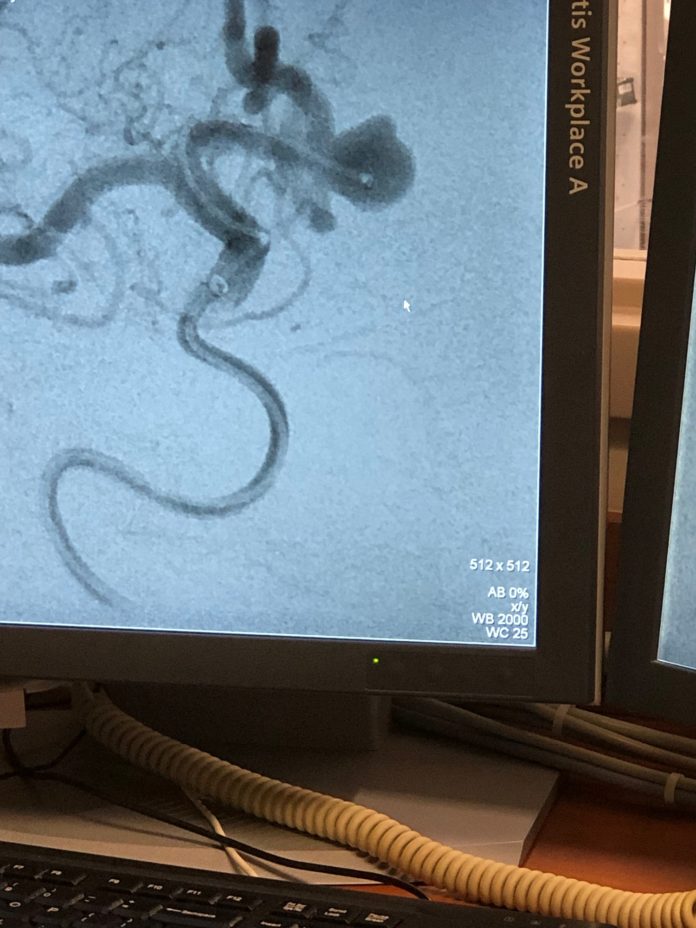 New 'game changing' minimally invasive treatment for brain aneurysms ...